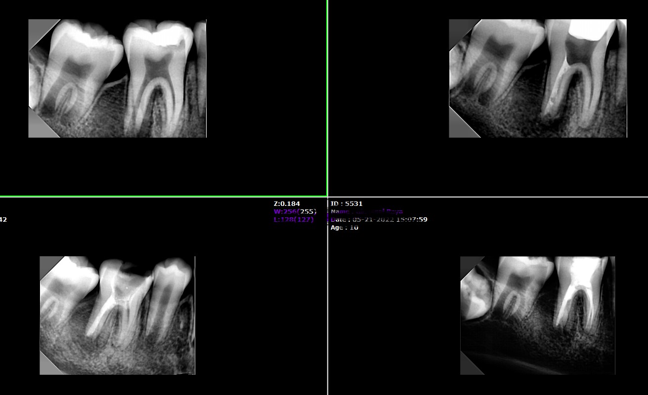 How to save teenagers’ teeth?Apexification or Root canal for open apex ...